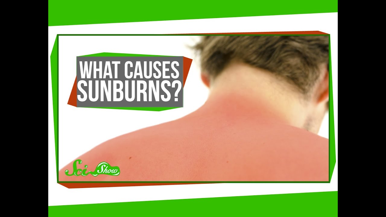 What Causes Sunburns?