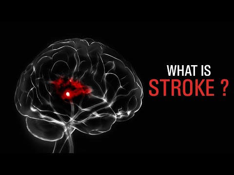 Is Stroke Deadly? Find Out | Dr. Purnendu Roy | Unfolds his Experiences |Severity|Remedies to Stroke