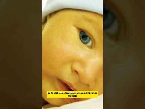 #shorts ⚠️👶❤️Ictericia en Recién Nacidos: Causas, Síntomas y Tratamiento #pediatría #sueñodelbebé