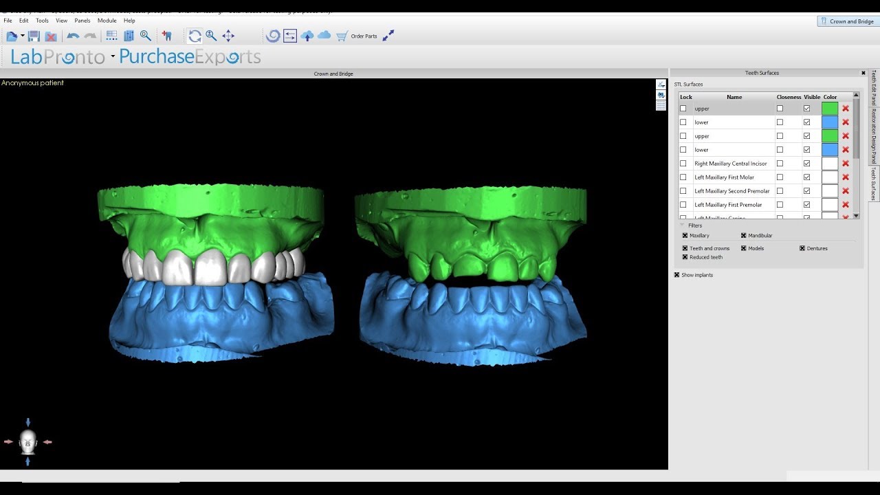 Digital Waxup Using Blue Sky Plan Crown and Bridge Module