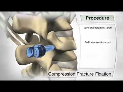 Compression Fracture Fixation Procedure Animation