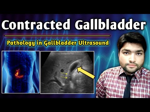 Case Study 1 | Contracted Gallbladder Finding by Ali Waqar