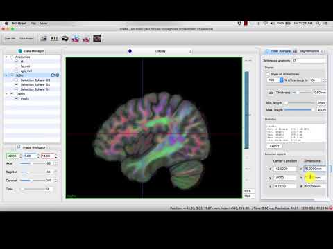 MI-Brain - Rough dissection of the arcuate fasciculus