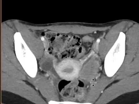 Melanoma metastases to Ovary