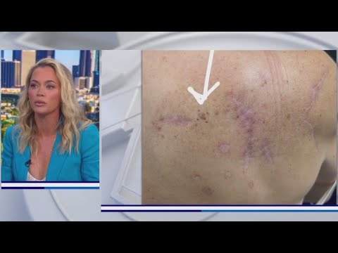 Real Housewives star shares personal battle with skin cancer
