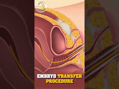 Embryo Transfer Procedure | Best Gynecology Doctor in Kanpur