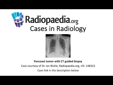 Pancoast tumor with CT guided biopsy (Radiopaedia.org) Cases in Radiology