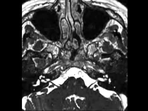 Abducens Nerve Palsy