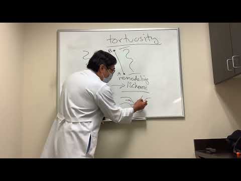 Venous tortuosity