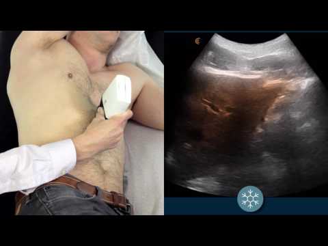 How to scan the gallbladder using portable ultrasound