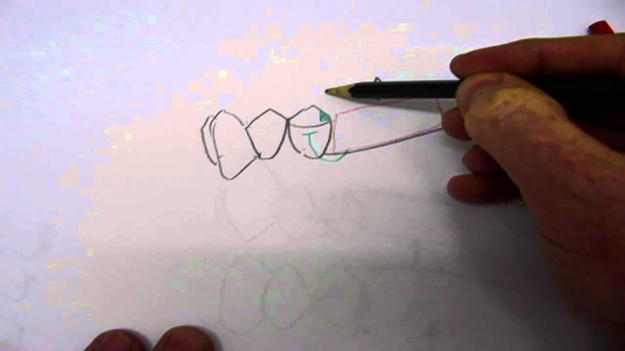 Removable Partial Denture Design Revision (part 2)