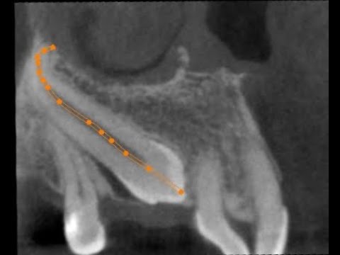 Autotransplantacja zęba zatrzymanego; tooth autotransplantation