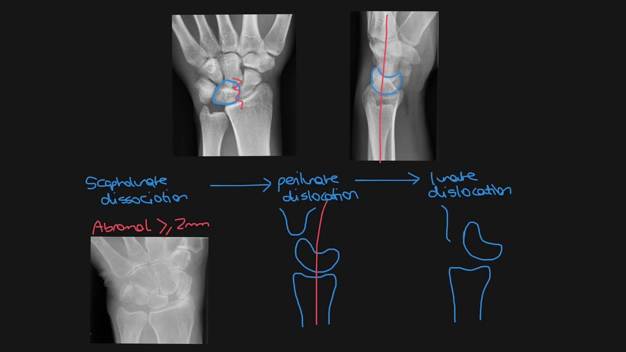 Carpal bone fractures