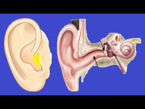 Yellow Discharge From Ears: Causes And Prevention