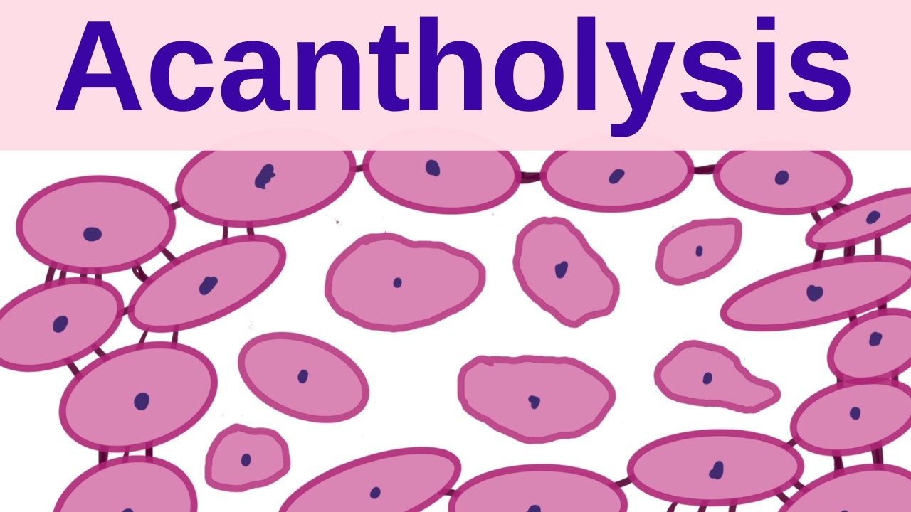 What is Acantholysis? - Pathology mini tutorials