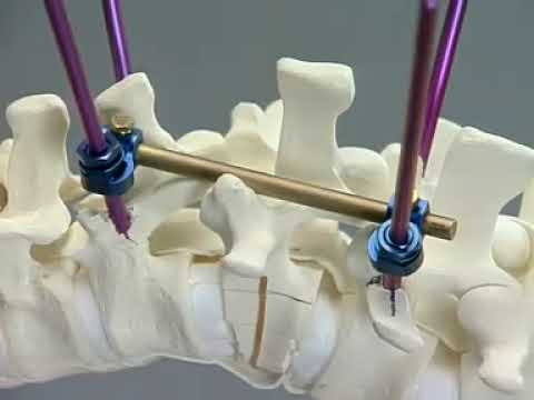 DepuySynthes: USS Fractures