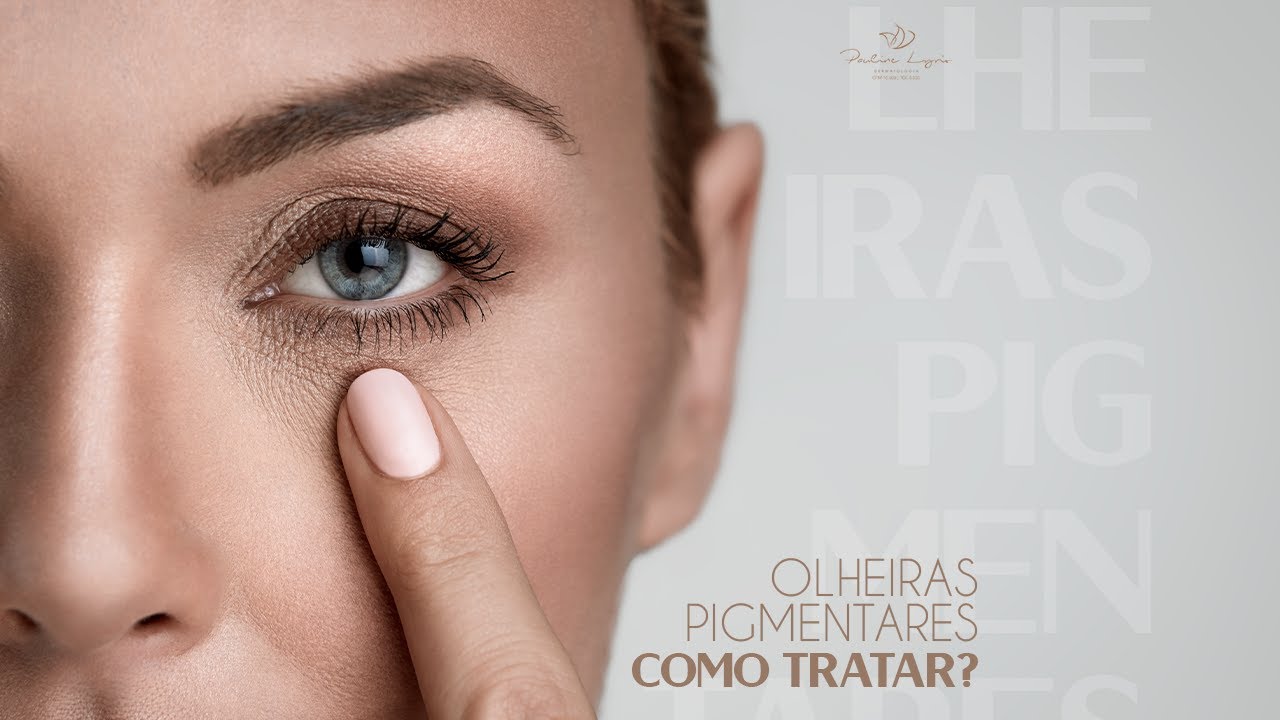 Como tratar as olheiras pigmentadas - Dermatologista em Vitória ES