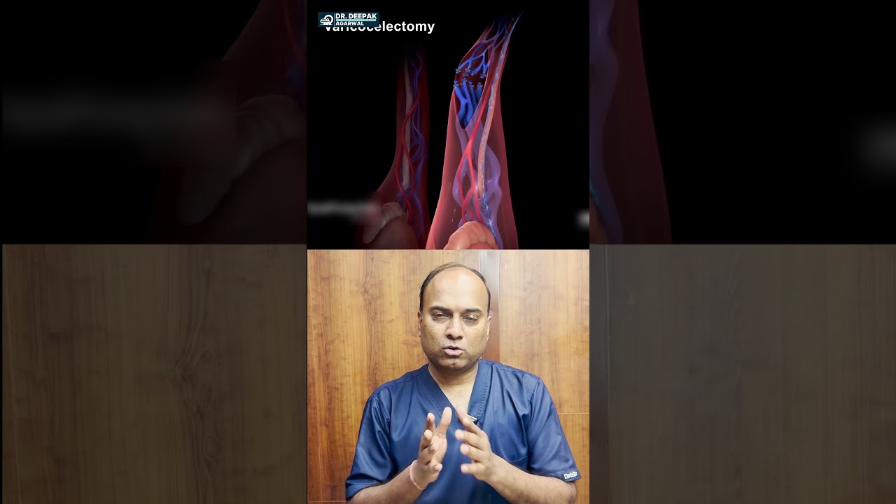 Varicocele ka Ilaaj Kaise Hota Hai? #varicocele #menshealth