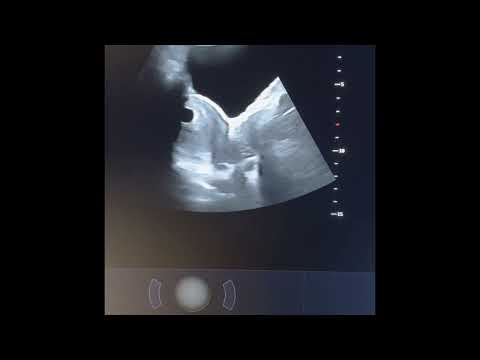 Free fluid in pouch of Douglas in ultrasound scan(POD free fluid)