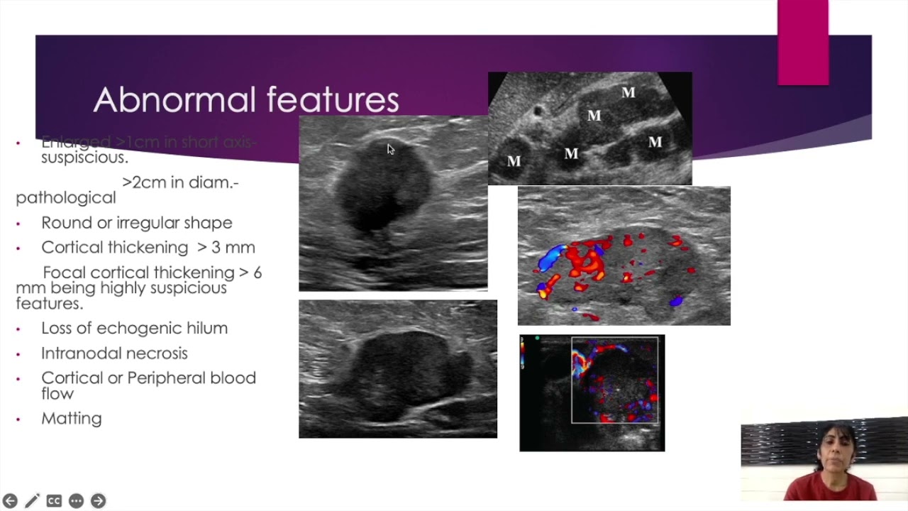 Benign vs Malignant lymph nodes