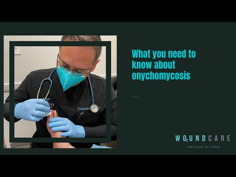 What do you need to know about onychomycosis