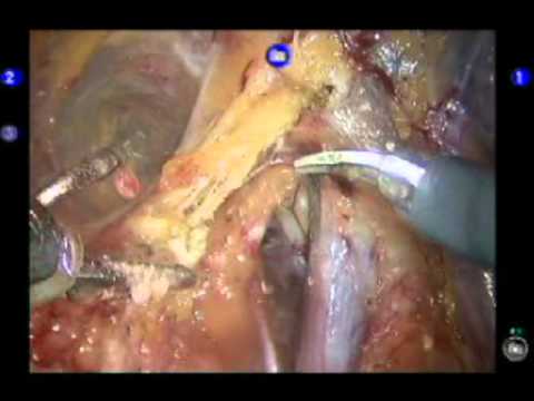 Robotic pelvic lymph node dissection for prostate caner