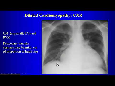 7 MRI of Myocarditis Cardiomyopathies