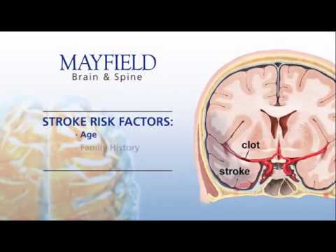 Mayfield Minute: Stroke Risk Factors