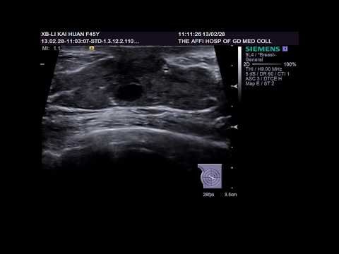 Asvide: An irregular, hypoechoic solid mass with cystic component located in the right breast...