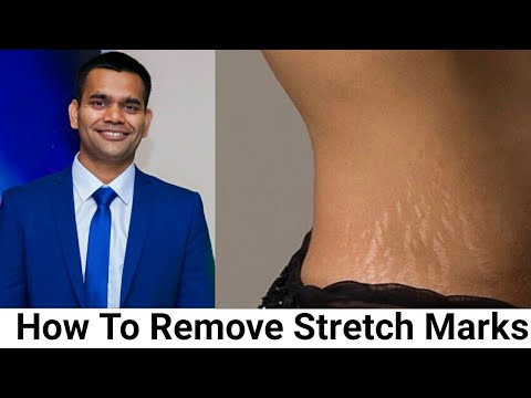 How To Remove Stretch Marks Fast | Home Remedy