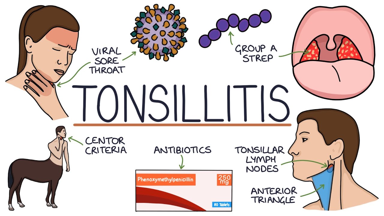 Understanding Tonsillitis