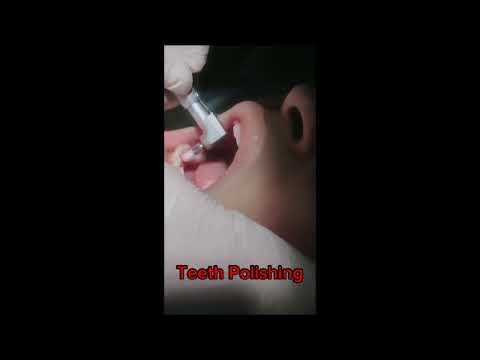 Teeth Polishing@Dr Samina Ismail