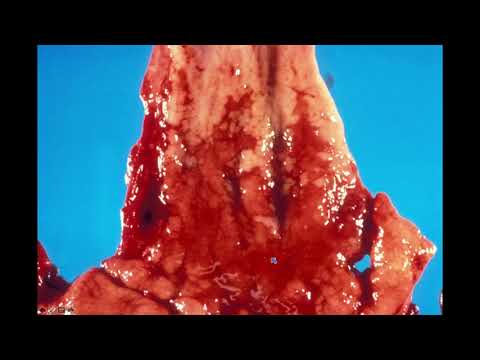 Controversies in the Diagnosis of Barrett's Esophagus and Barrett's-Related Dysplasia