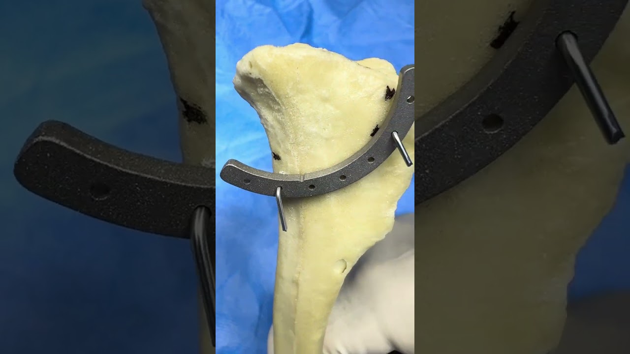 TPLO Osteotomy Guide - Sawbones Demonstration Utilizing the Guide & K-Wire as Rotational Landmarks