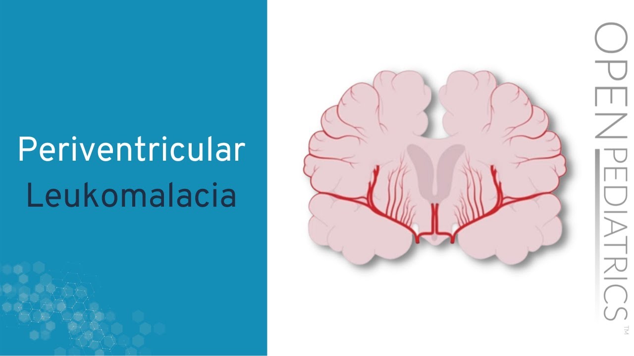Periventricular Leukomalacia by A. Hansen | OPENPediatrics