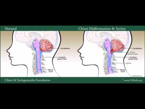 Chiari Malformation & Syringomyelia