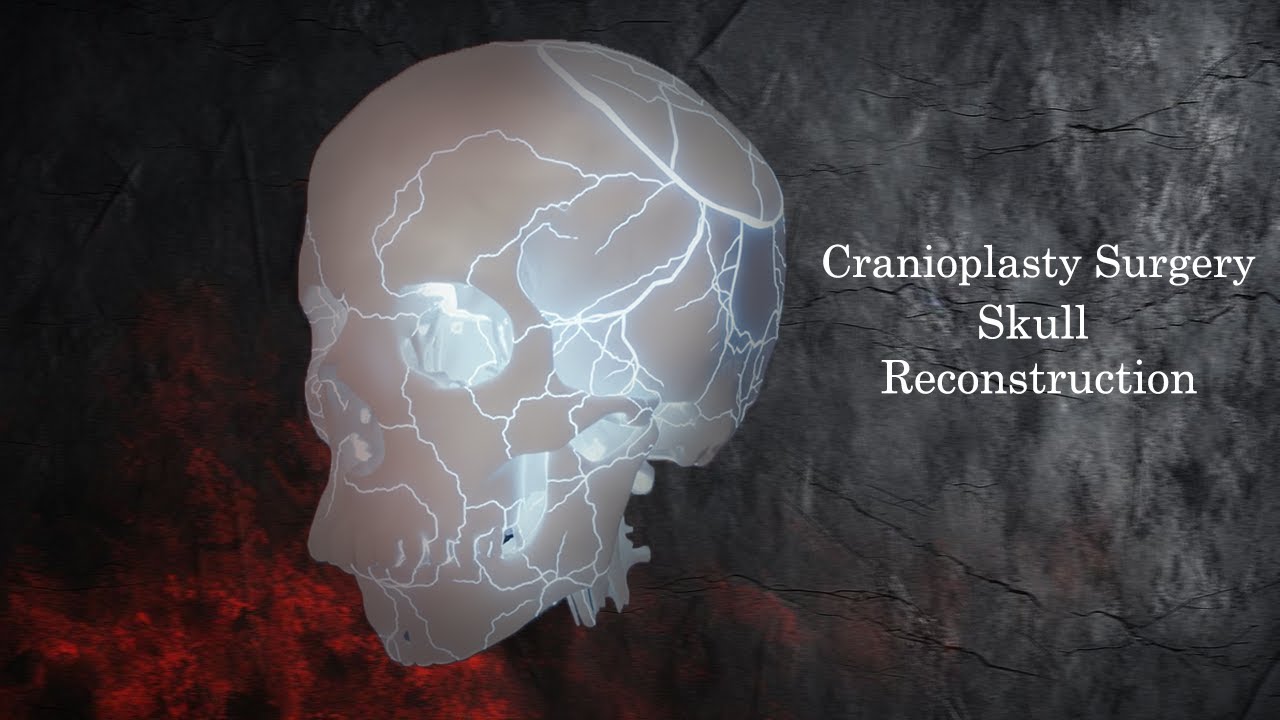 Cranioplasty Surgery Explained in 3D | Skull Reconstruction