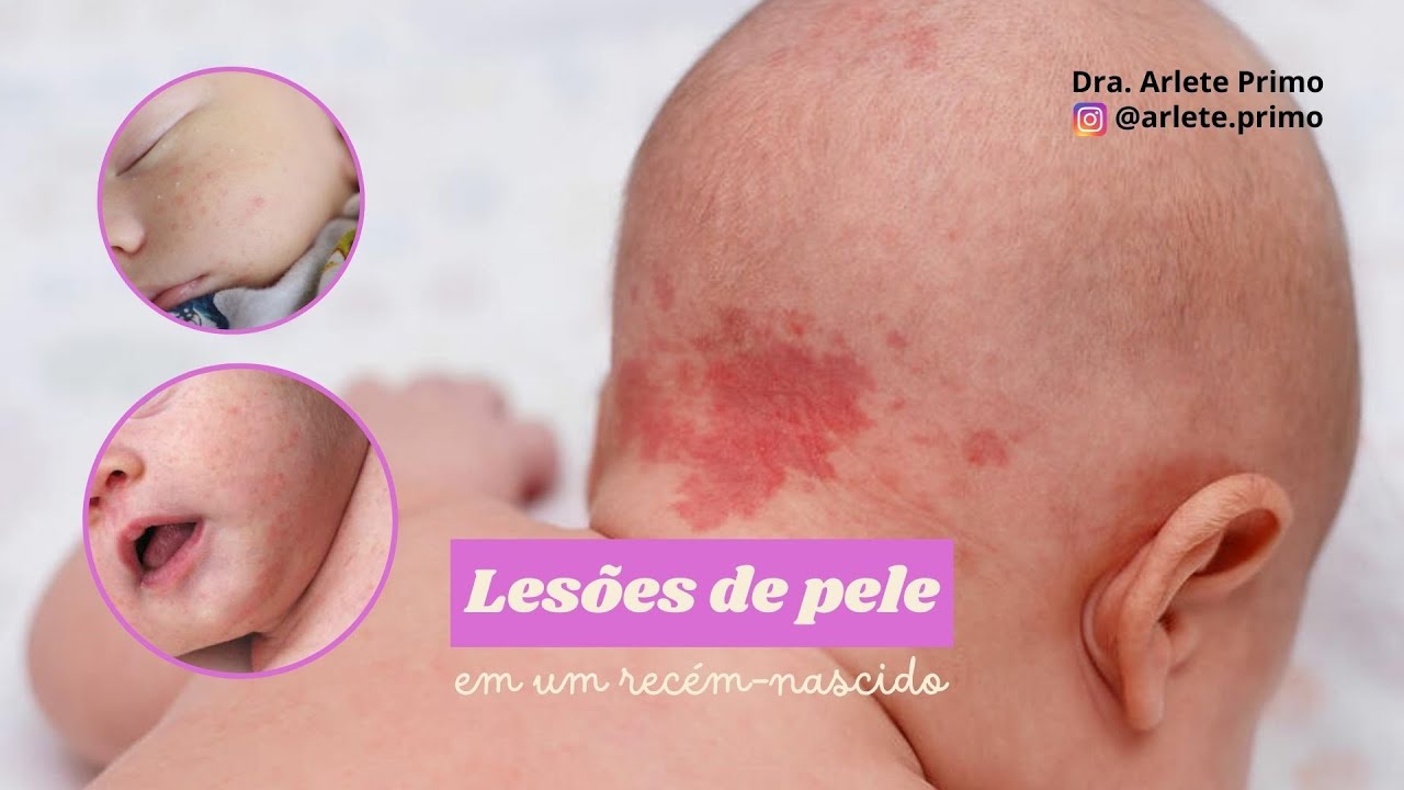 5  Lesões de pele comuns no recém nascido