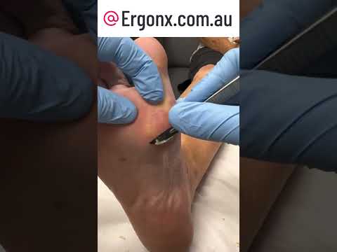 Painful foot callus removed by podiatrist with scalpel