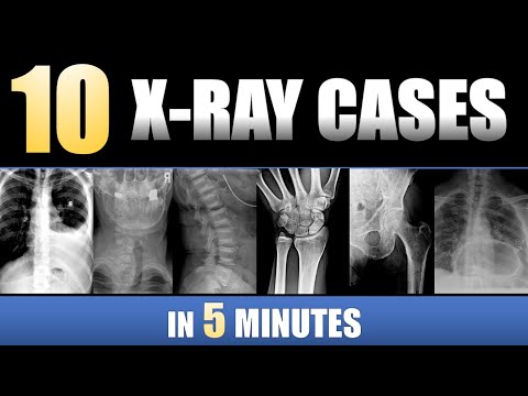 10 X-Ray Cases in 5 minutes #radiology #doctor #bones
