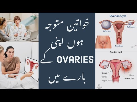 Ovarian Cysts in Urdu