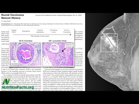 Breast Cancer Survival and Lignan Intake