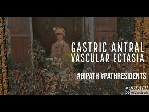 Gastric antral vascular ectasia watermelon stomach
