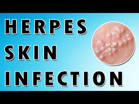 Herpes Simplex Virus Symptoms and Treatment