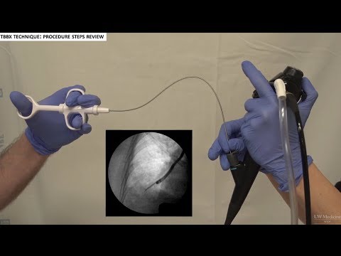 Transbronchial Biopsies -- BAVLS