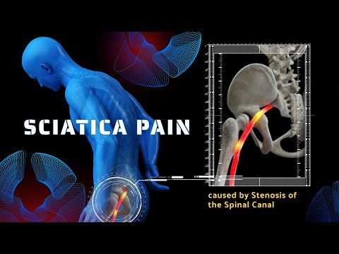 Sciatica Pain: Spinal Stenosis: Narrowing the Path for Pain Relief | Massage | Exercises