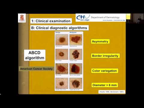 Arjen Nikkels. Melanoma from Clinical Diagnosis to digitized Dermoscopy