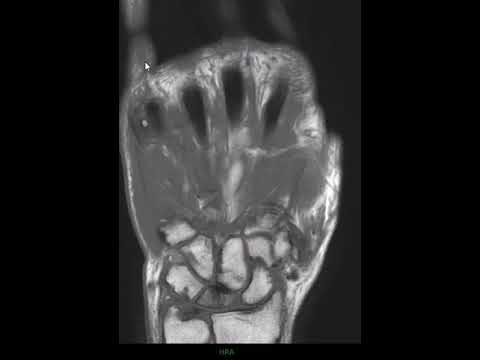 Torn 5th flexor digitorum profundus tendon of hand.