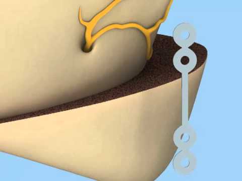 Genioplasty