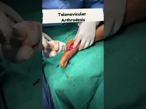 Foot pain surgery | Midfoot arthritis #footpain #neetmotivation #footpainrelief